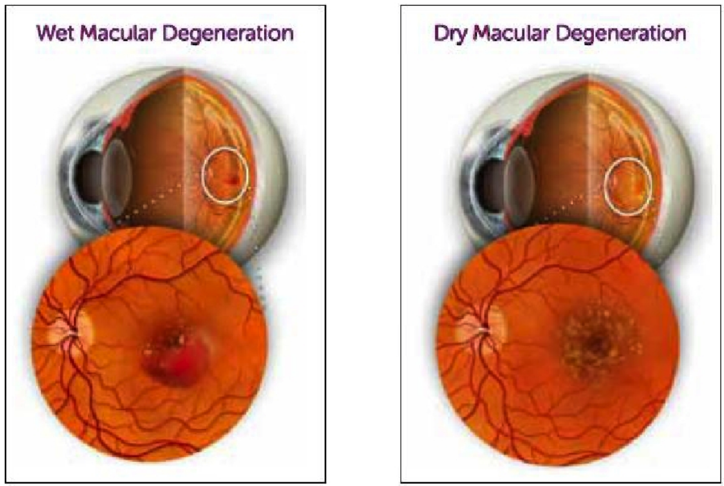 Macular Degeneration 5 Things You Need To Know Dr Annie